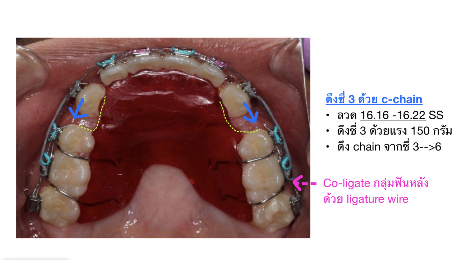 Anterior bite plane 1 ชิ้น กับงานจัดฟันในหลายมิติ - Keyconcept Ortho